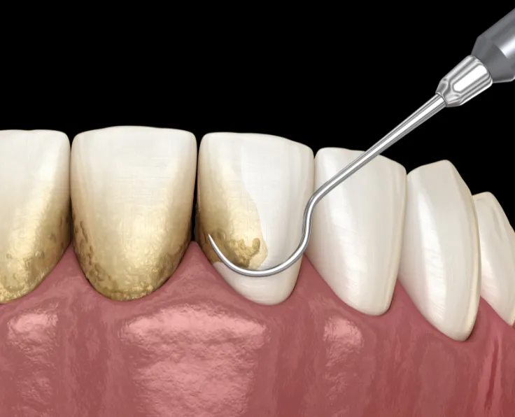 Scaling Treatment - Oraa Care